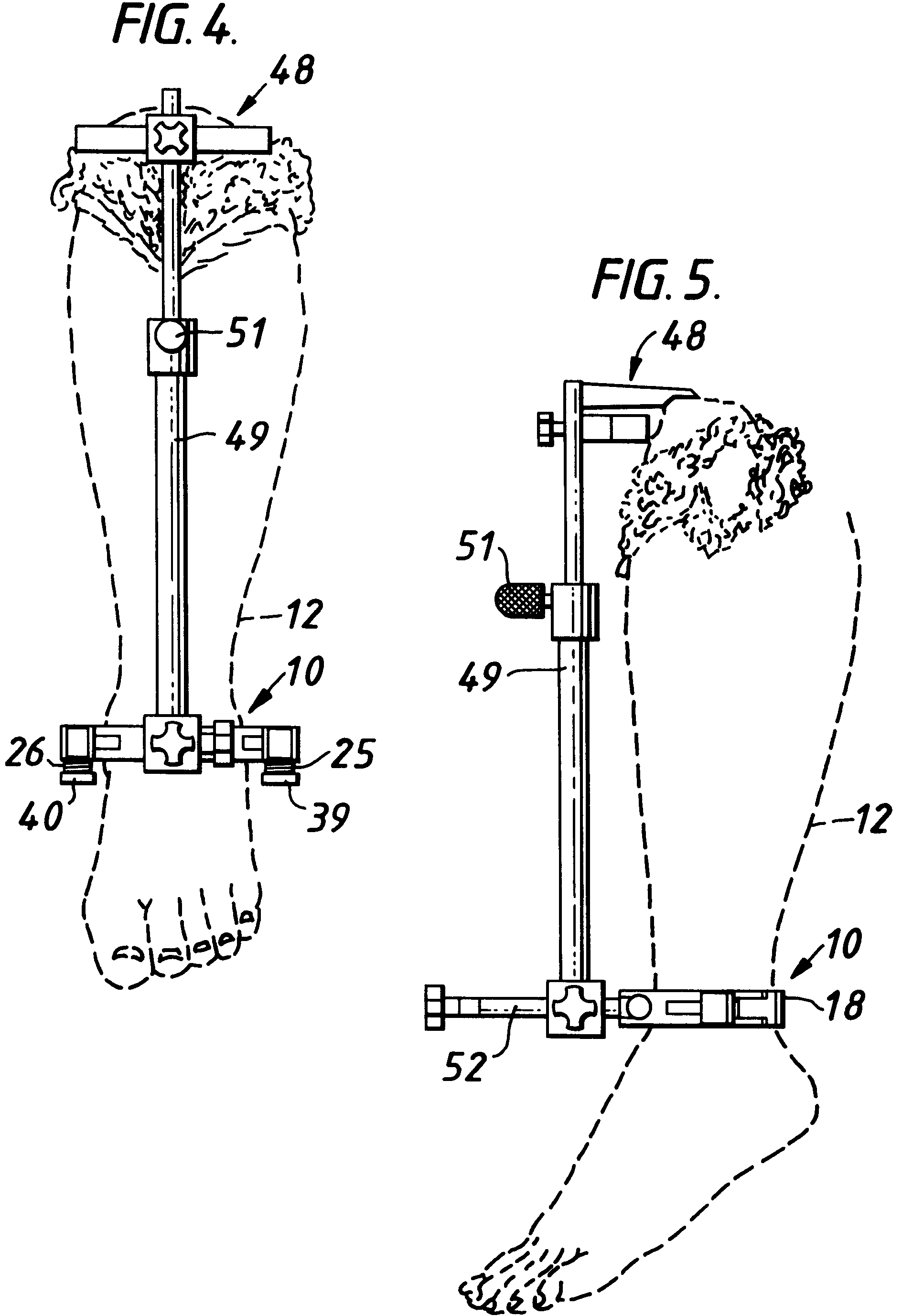 Patent EP0564176A1 - Ankle clamp - Google Patents
