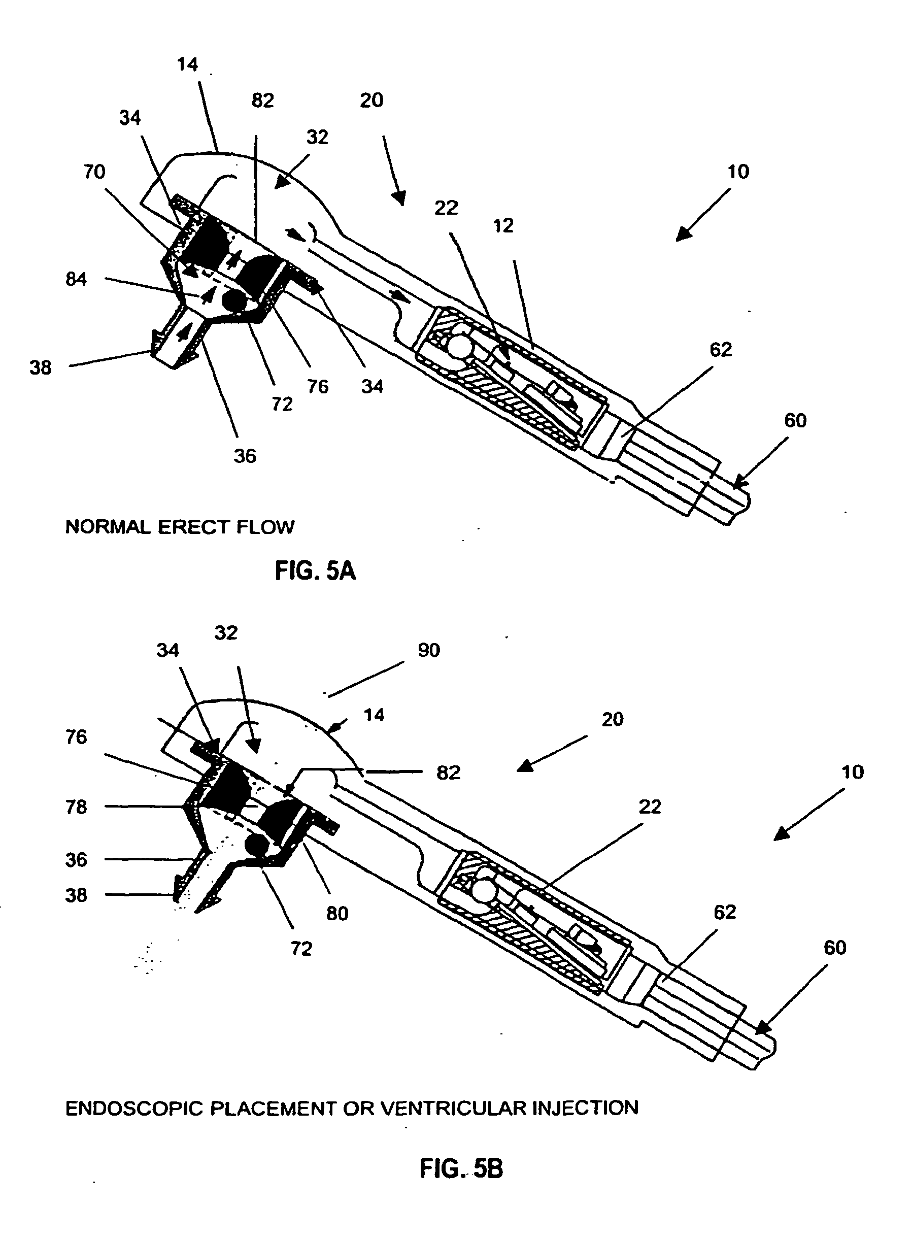 Patent EP1462144B1 - Hydrocephalus shunt system with endoscopic ...