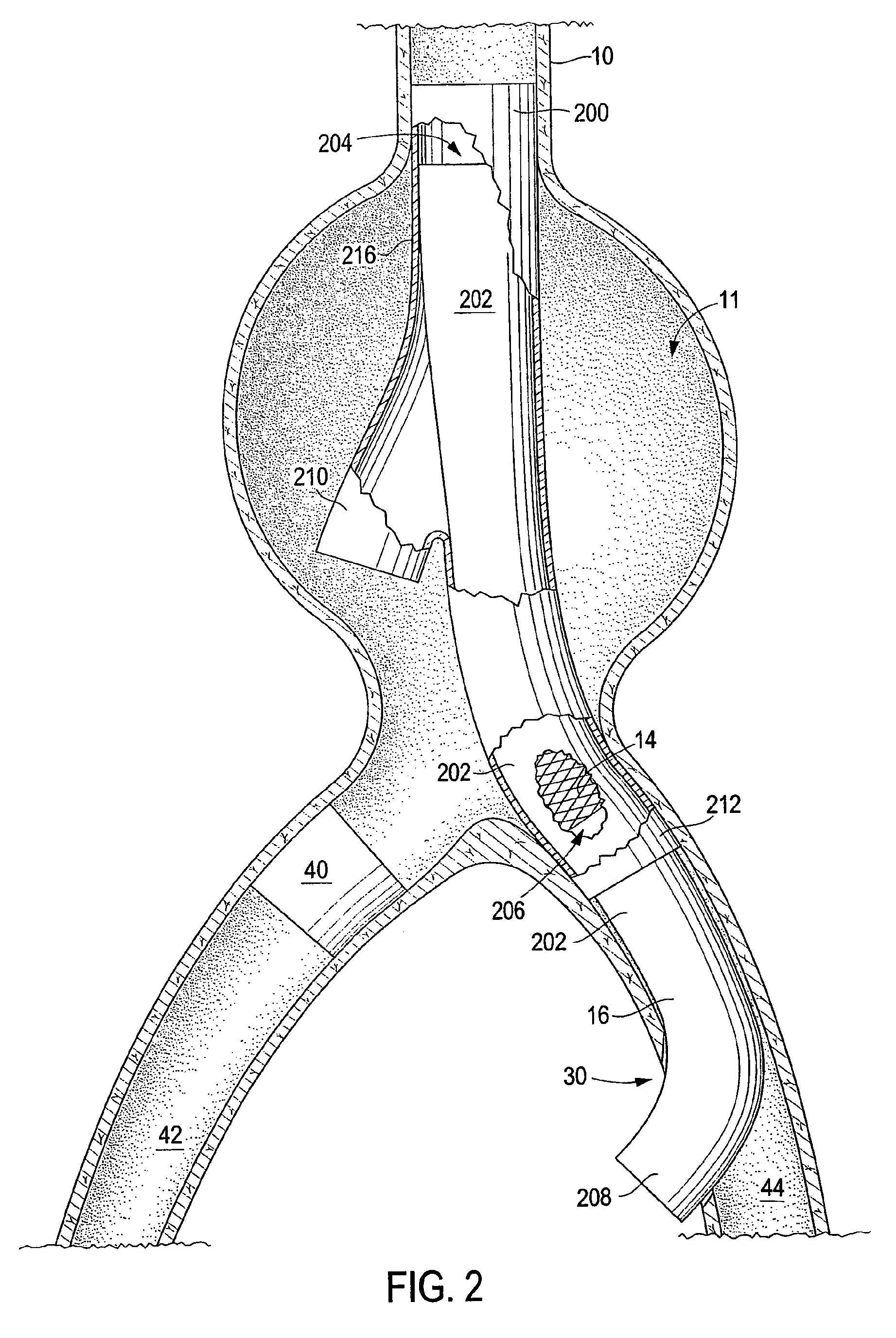 Stent Patents Pyeloplasty Internal External Sketch Coloring Page
