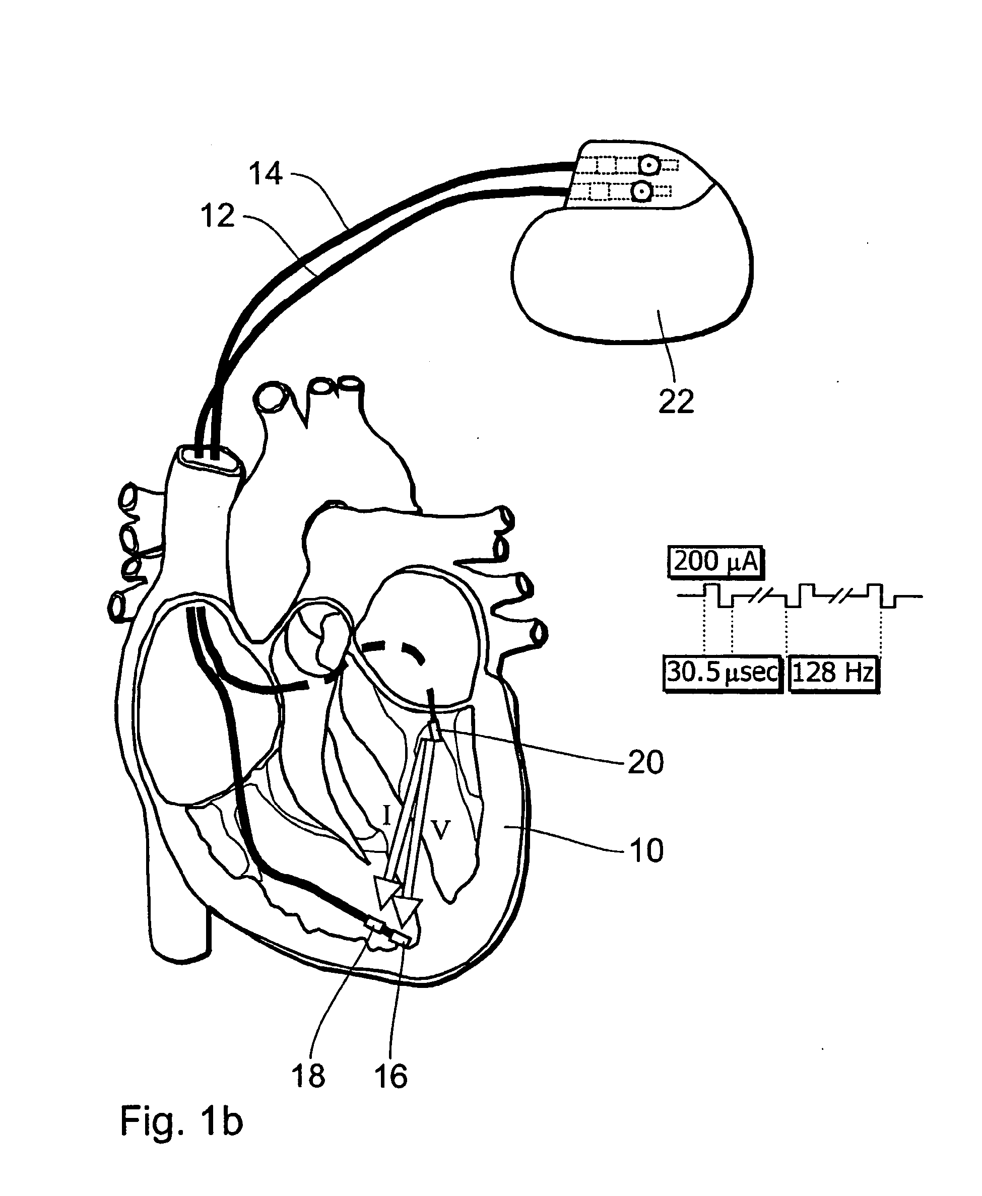 Patent EP1569715B1 - Biventricular cardiac pacemaker for cardiac ...