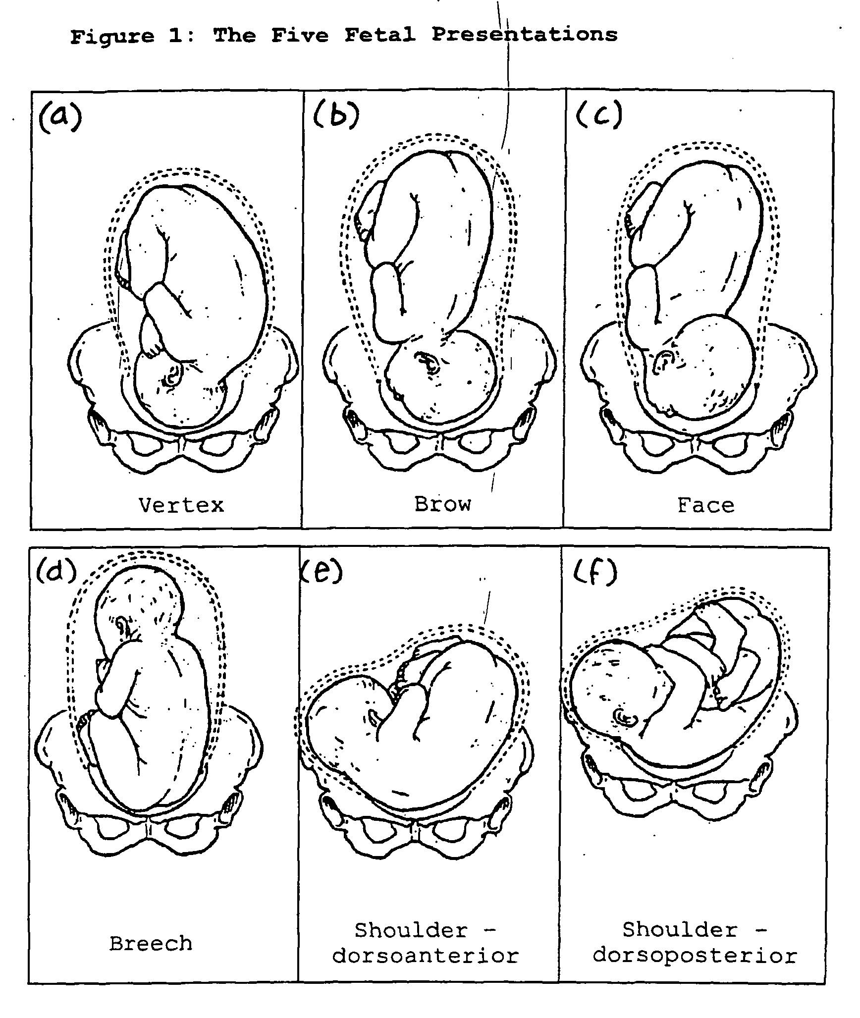 Uterusfetus Model Set Of 5 Childbirth Graphics