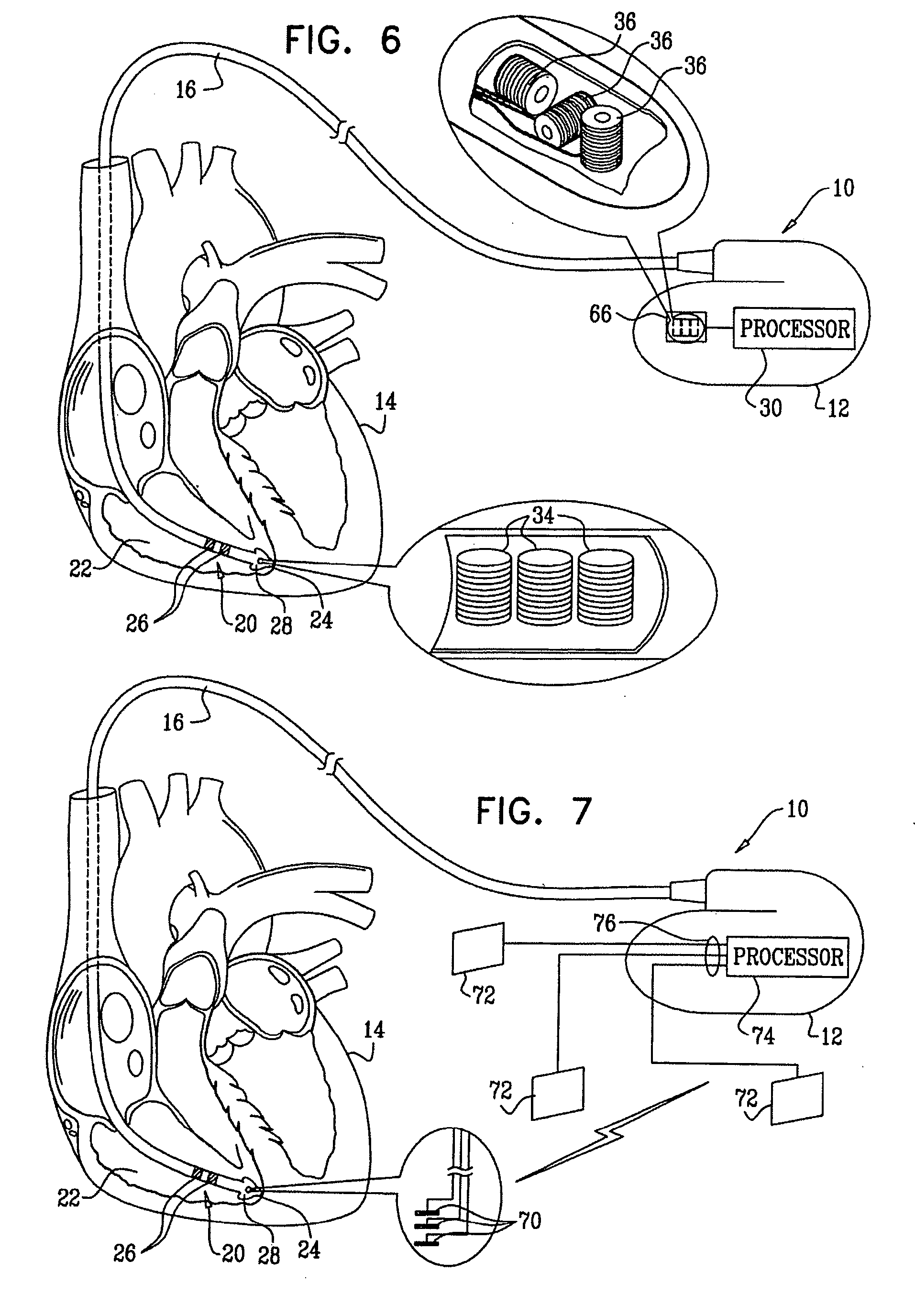 Patent EP2158938A1 - Pacemaker with position sensing - Google Patents