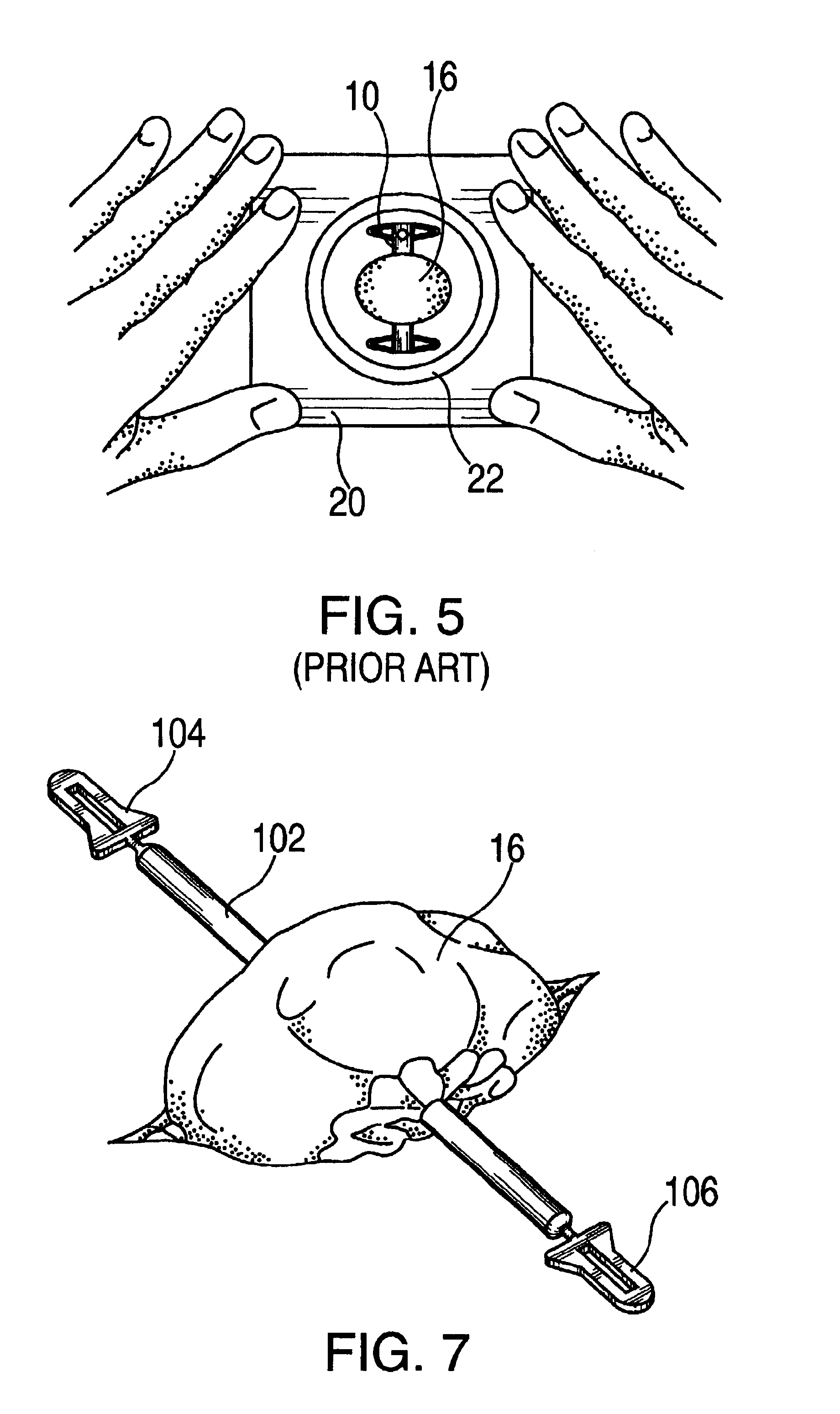 Patent US6716209 - Loop ostomy device and methods for its use - Google ...