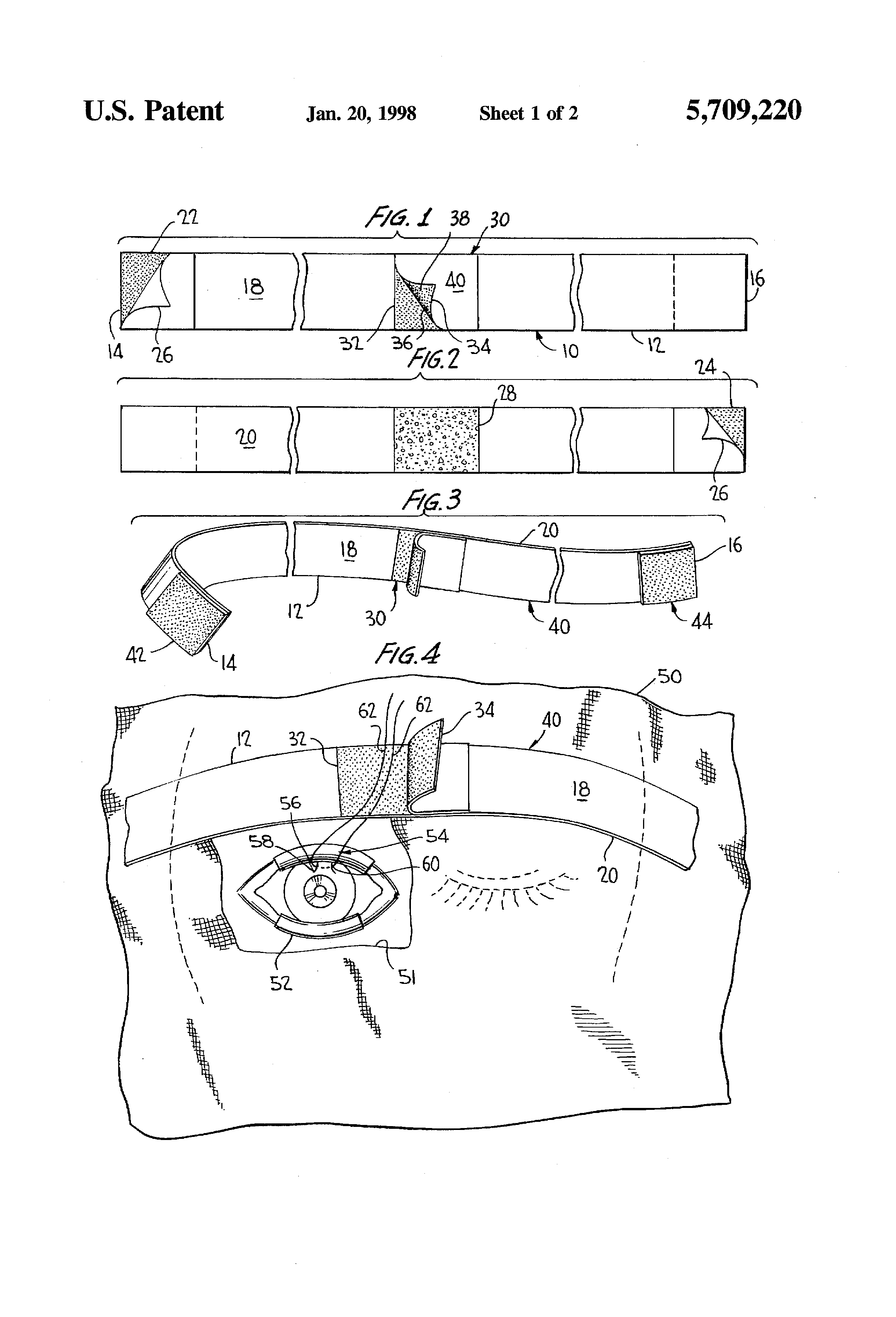 Patent US5709220 - Head stabilizer and superior rectus bridle suture ...