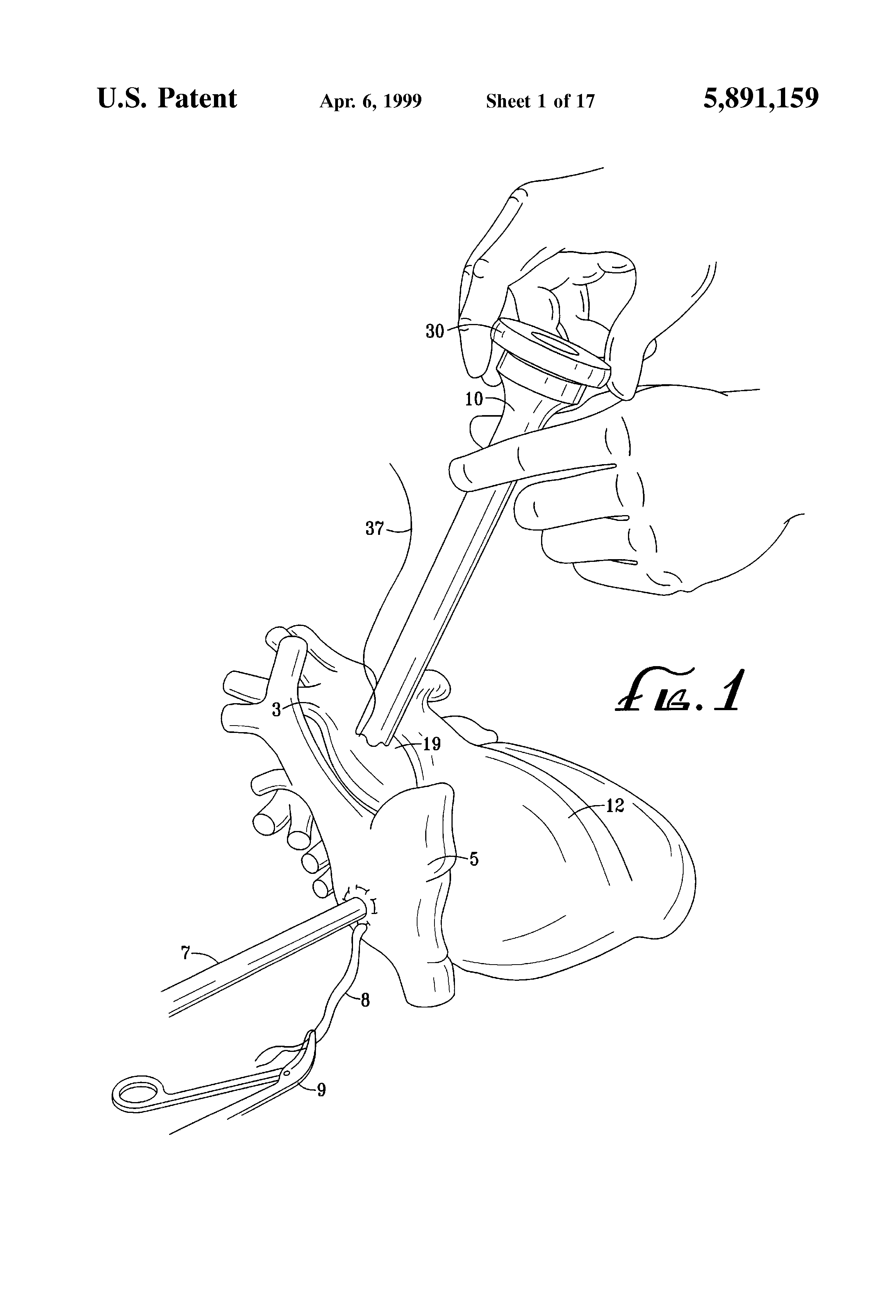 Patent US5891159 - Automatic purse string suture device - Google Patents