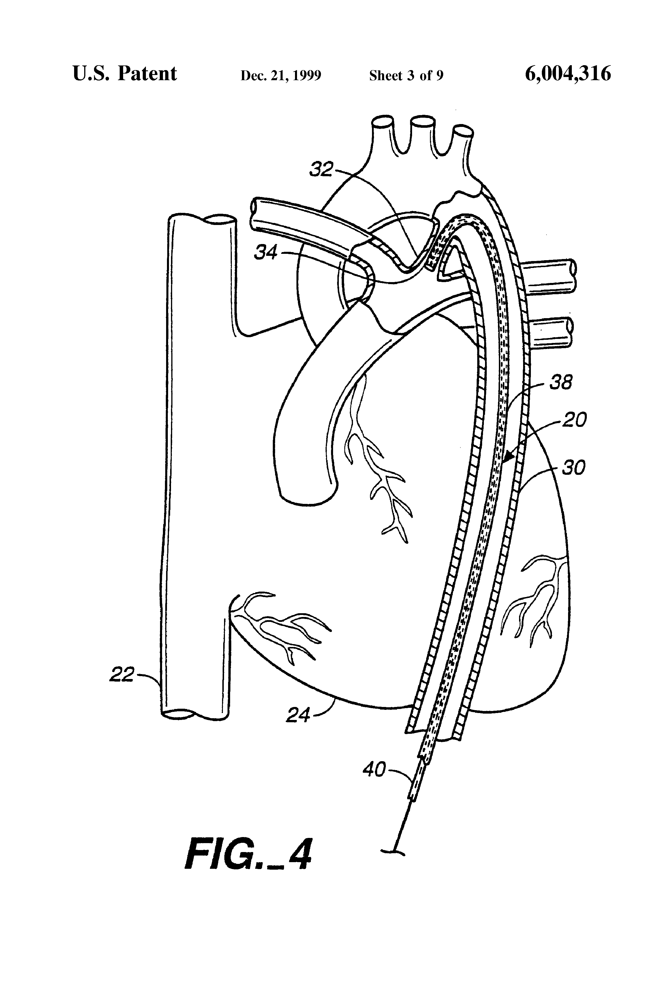 Patent Arteriosus Ductus Patents Treatment Method Sketch Coloring Page