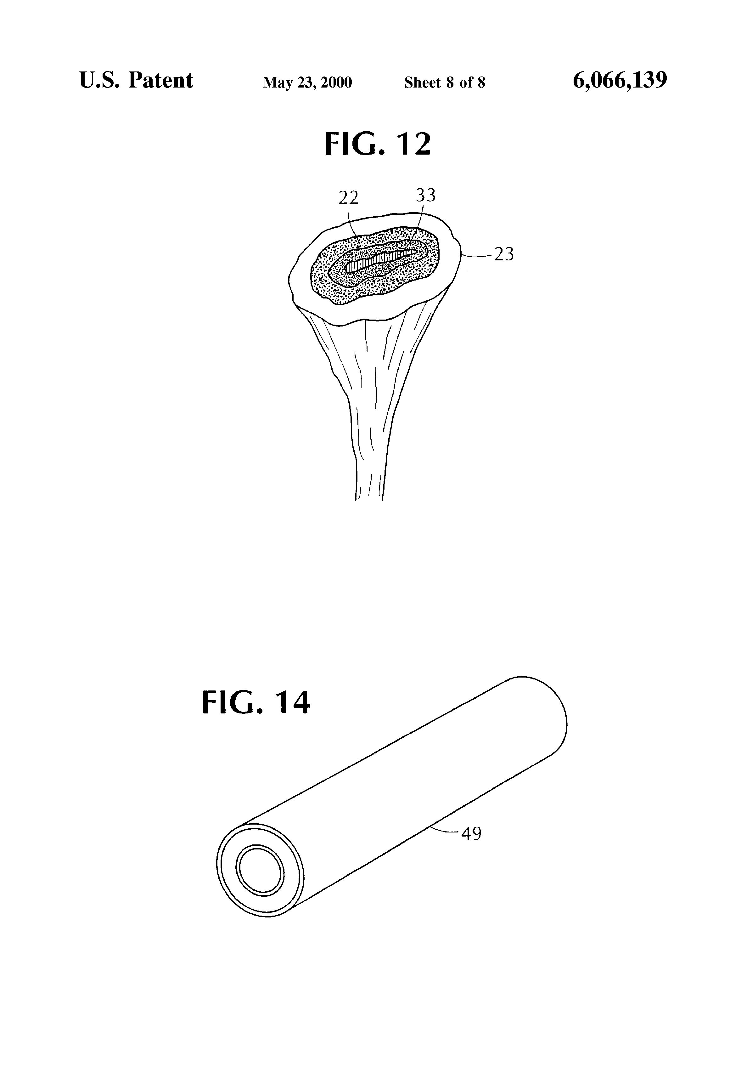 Transcervical Sterilization Laparoscopic Sterilization
