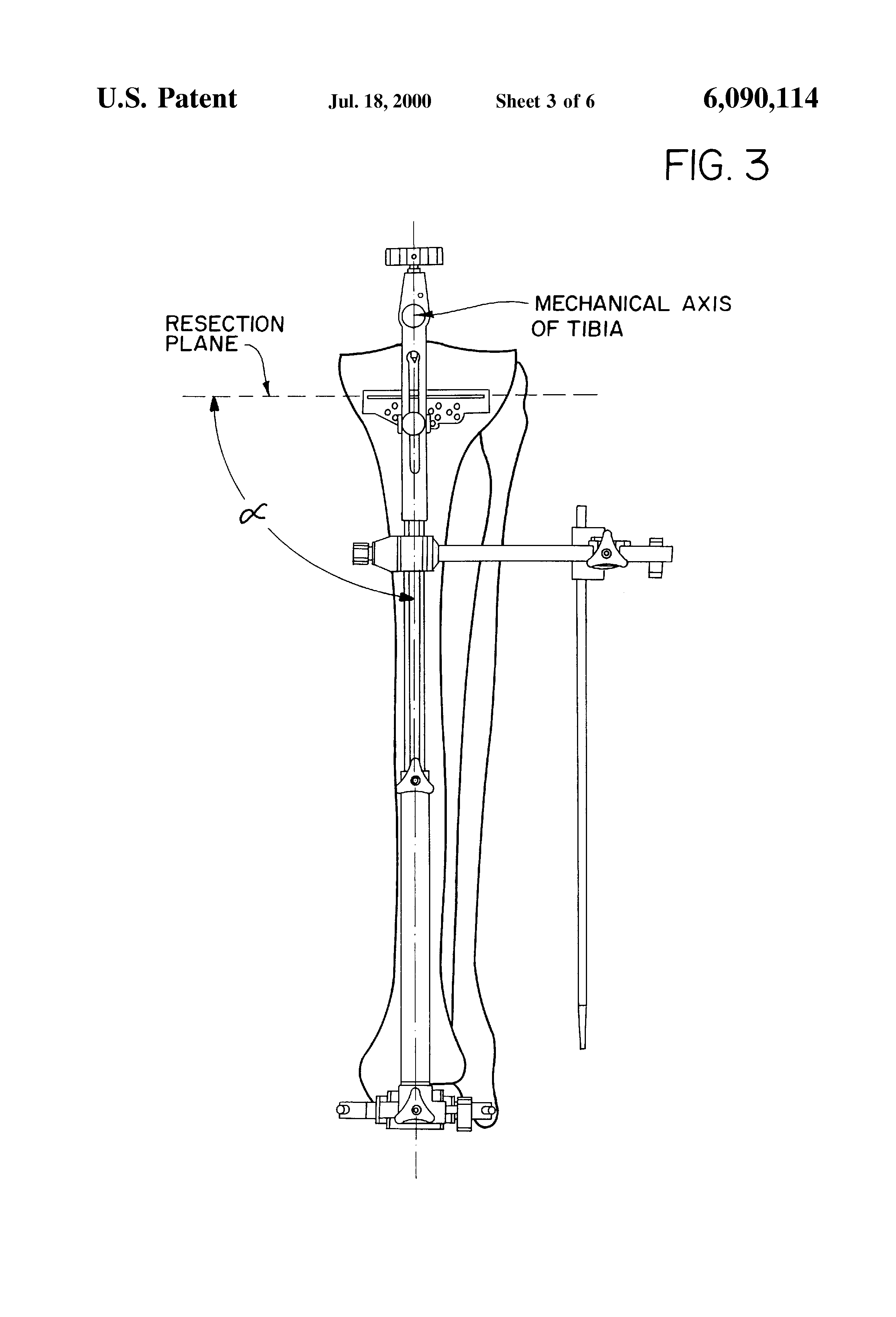 Brevet US6090114 - Tibial plateau resection guide - Google Brevets